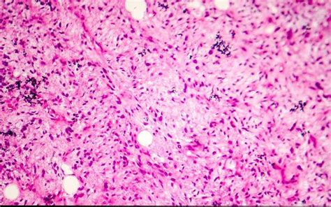What Is Undifferentiated Pleomorphic Sarcoma Klarity Health Library