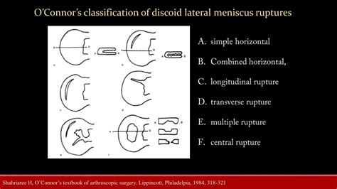 Ppt Discoid Meniscus Treatment Powerpoint Presentation Free Download Id9391922