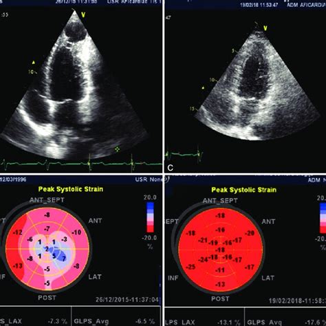 A Four Chamber View Of Transthoracic Echocardiogram Demonstrating