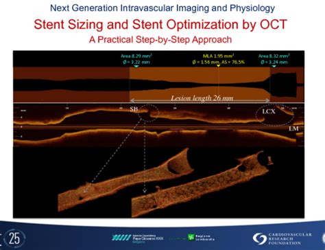 Stent Sizing And Stent Optimization By Oct A Practical Step By Step