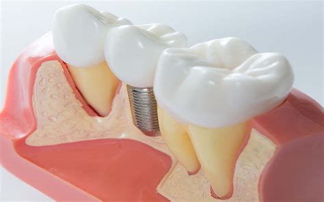 Dental Implant Or Bridge Which Is Ideal For You Nha Khoa Sydney