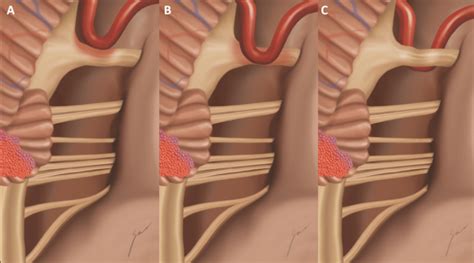 Causes That Lead To The Need For Microvascular Decompression Mvd Surgery In India