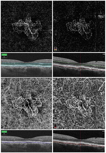 Spectral Oct Retina