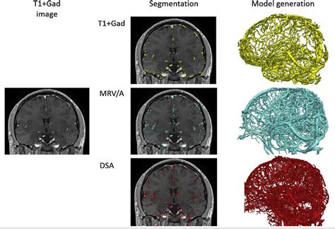 Examples Of Vessel Segmentations From T11gad Left Column Mrvmra