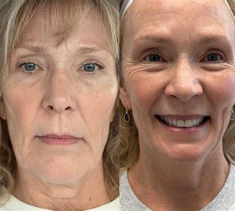 Gallery St Louis Vascular Surgical Specialists
