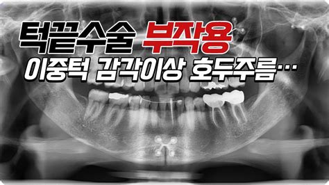 턱끝수술 후 부작용인 이중턱 턱끝조임 뭉침현상 신경손상 등등 Youtube