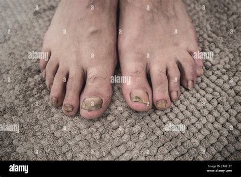 Onicomicosis infección micótica de las uñas con dos pies Fotografía de