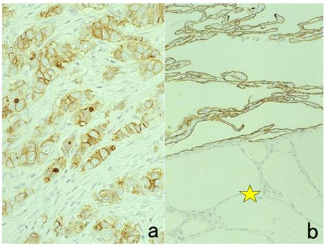Plasma Membrane Localization Of Ki 67 A Breast Cancer And B Lung