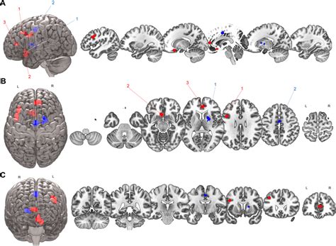 Map Of Brain Activations And Deactivations Associated With Placebo