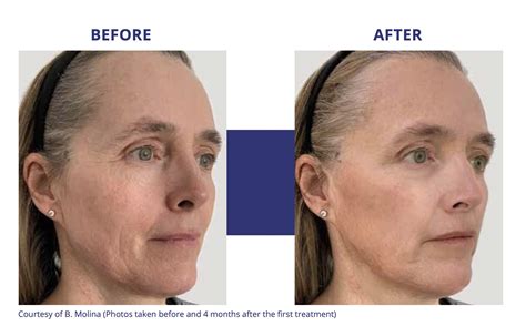 Profhilo Structura Treatment Before And After Photos Skin To Love