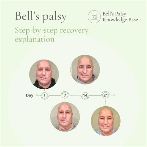 How Similar Is Ramsay Hunt Syndrome To Bells Palsy • Crystal Touch