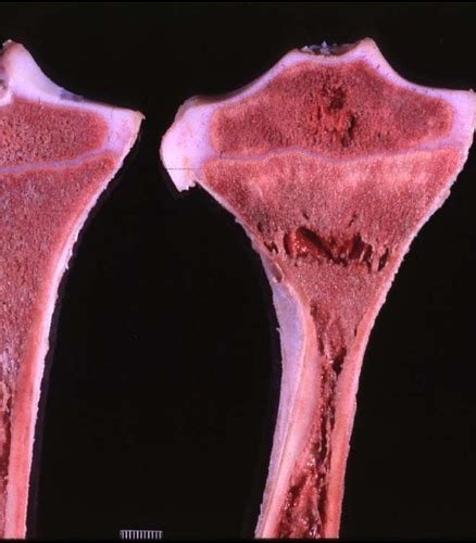 Bone Pathology Flashcards Quizlet
