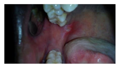 Ulcer At The Retromolar Region Of The Mouth Download Scientific Diagram