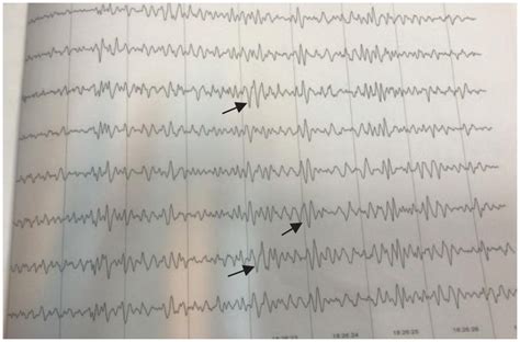 Electroencephalography Demonstrated Diffuse Slow And Sharp Black Download Scientific Diagram
