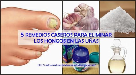Carlos Martinez M La Buena Salud Al Alcance De Todos REMEDIOS CASEROS PARA ELIMINAR LOS