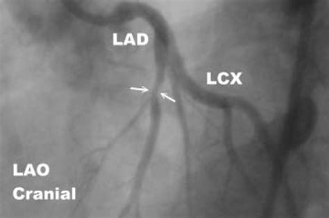 Recanalised Significant Lad Stenosis Just After The First Diagonal