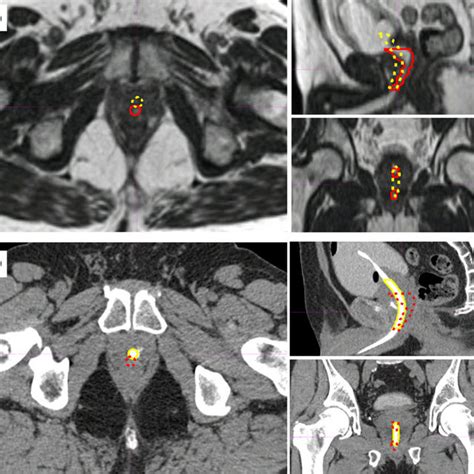 Pdf Visualising The Proximal Urethra By Mri Voiding Scan Results Of A Prospective Clinical
