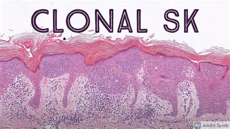 Seborrheic Keratosis Histology