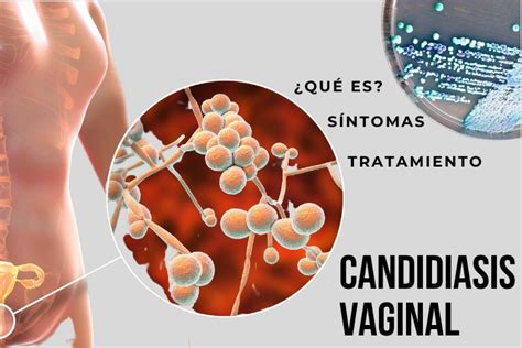 Candidiasis Vaginal Tratamiento