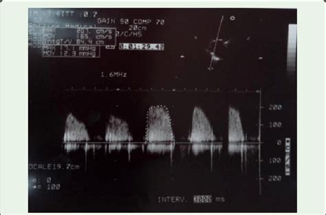 Transthoracic Echocardiograms Shows Mean Transvalvular Gradients Of 12 Download Scientific