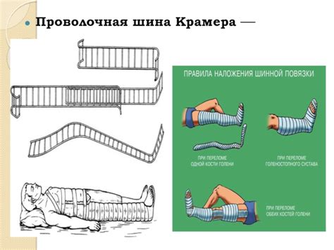 Шины для транспортной иммобилизации конечностей: