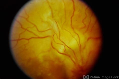 Peripapillary Choroidal Neovascular Membrane Cnvm With Angioid Streaks Retina Image Bank
