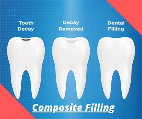 Dr Sai Anusha Reddy On Linkedin Advisdentalclinic Dentist