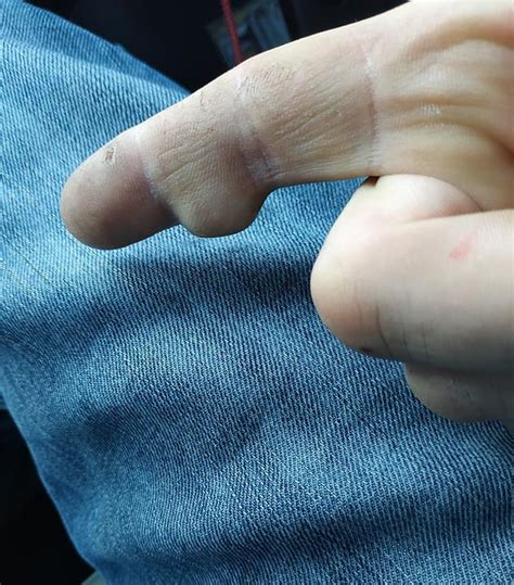 Aggressive Digital Papillary Adenocarcinoma Adpaca Is A Malignant