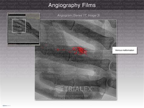 Angiography Films Trialquest Inc