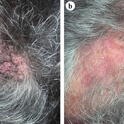 Case Presentation Of A 65 Year Old Male Patient Affected By Sebaceous Download Scientific