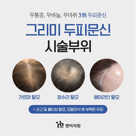 엔비의원 V 무통증 V 무바늘 V 무마취 그리미 두피문신 가르마 탈모 정수리 탈모 헤어라인 탈모 비수술적 방법으로 통증은 적게 탈모 개선 효과는 높게 관련해
