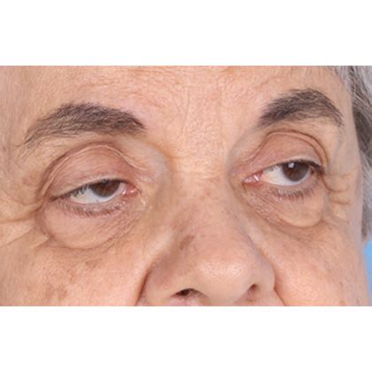 Patient 626 Ptosis Repair Before And After Photos Chicago IL