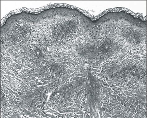 Figure 1 From Intramural Hematoma Of The Duodenum Following Endoscopic