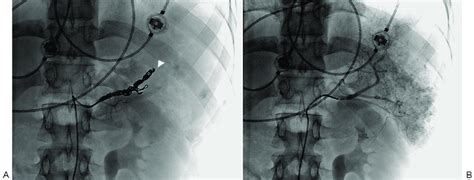 A Angiography Shows No Extravasation B Preemptive Embolization Of