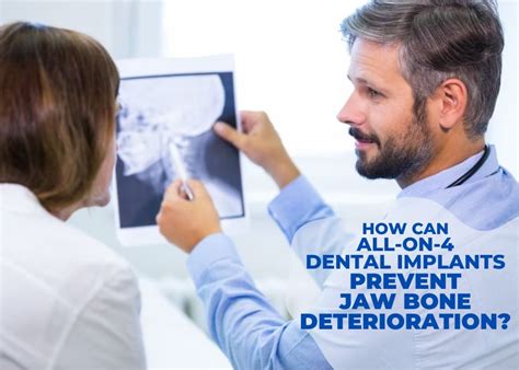 How All On 4 Implants Prevent Jaw Bone Deterioration