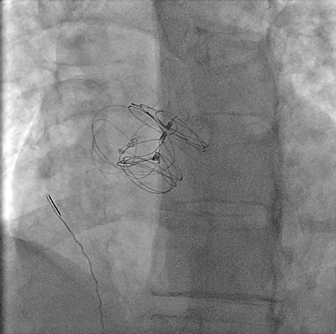 Fluoroscopy Showing Placement Of A 30 Mm Cardioform Device Adjacent To Download Scientific
