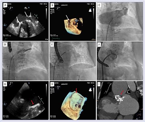 A Two Dimensional Transesophageal Echocardiography 2d Tee View