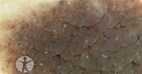 Globular Pattern Dermoscopy Image