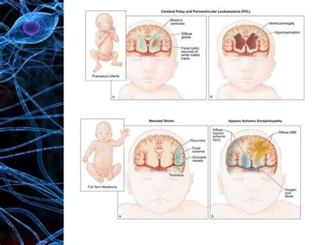 Hypoxic Ischemic Encephalopathy Pptx