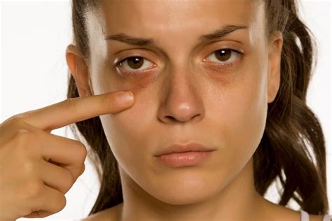 How To Get Rid Of Dark Circles And Bags Under Eyes At The Same Time