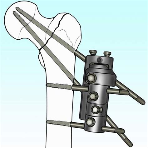 The Patient Is Positioned On A Fracture Table And Fracture Reduction