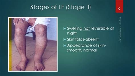 Lymphatic Filariasis Ppt 1014