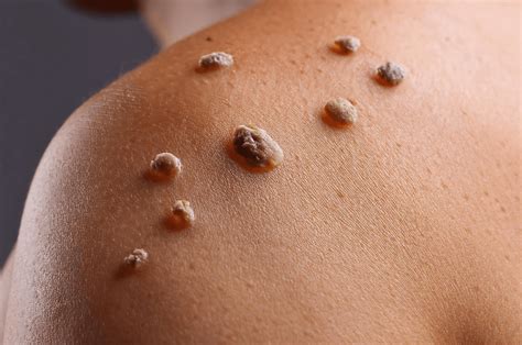 Learn About Warts Types Documentation With Icd 10 Codes