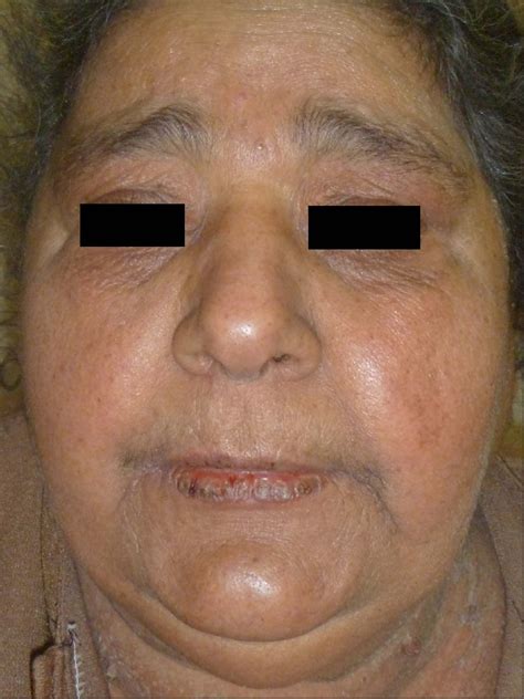 F Drug Reaction With Eosinophilia And Systemic Symptoms Dress