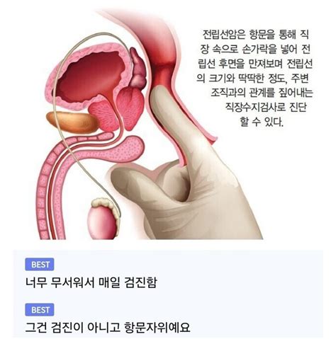 전립선암 자가진단 방법 유머움짤이슈 에펨코리아