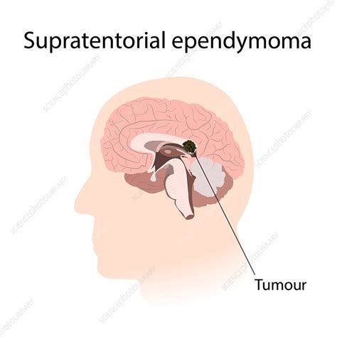 Supratentorial Ependymoma Illustration Stock Image F0327704