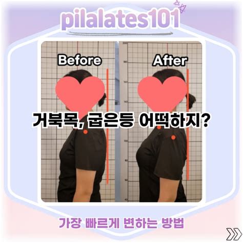 현대인이라면 누구나 겪어본 거북목과 굽은 등 요즘 들어 목과 어깨가 불편하고 심하면 통증까지 생기나요 마사지로 주물러도