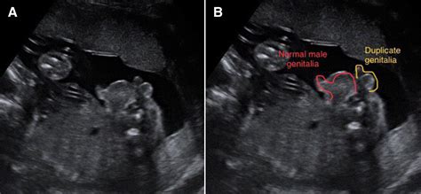 Prenatal Diagnosis Of Concomitant Accessory Scrotum And Diphallia In