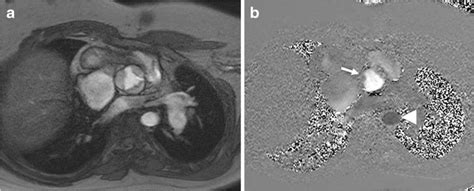 Two Dimensional 2 D Phase Contrast Imaging A B Oblique Axial