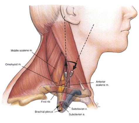 Supraclavicular Brachial Plexus Block Spinal Anaesthesia Of Upper